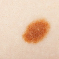 Wat is een melanoom? – Ingelicht